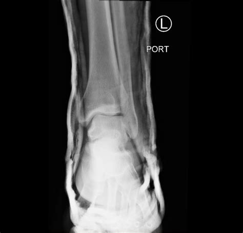 Medial Subtalar Dislocation A Case Report Jetem