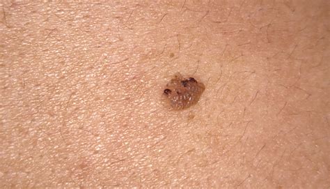 What Does Melanoma Look Like In The Early Stages Symptoms And Pictures