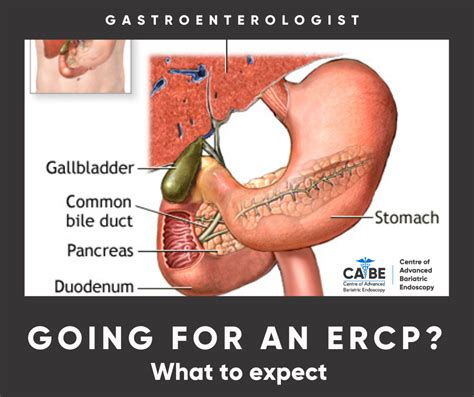 What Is An Ercp And What Is The Purpose A Gastroenterologist Who Is