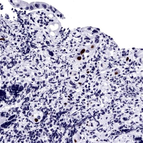 Positive Nuclear Immunohistochemical Staining For Cmv Supports The