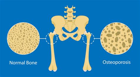 When To Have A Bone Density Scan For Osteoporosis