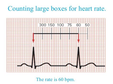 Ecg Basics 1