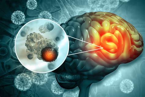 Brain Cancer Greater Waterbury Imaging Center