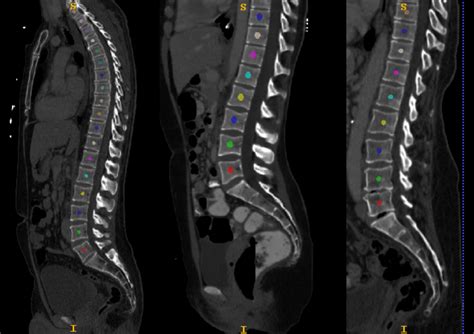 Examples Of Binary Spine Segmentation Download Scientific Diagram