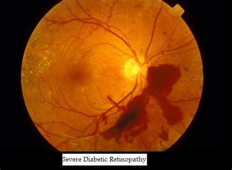 Eyesite Diabetes And The Eye