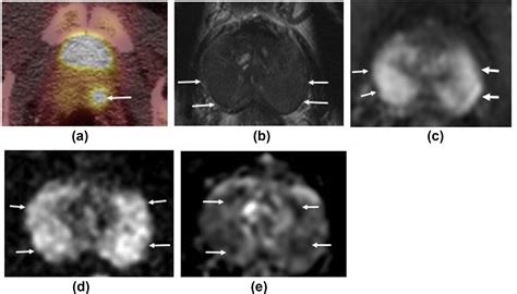 Prostatitis Imaging Appearances And Diagnostic Considerations