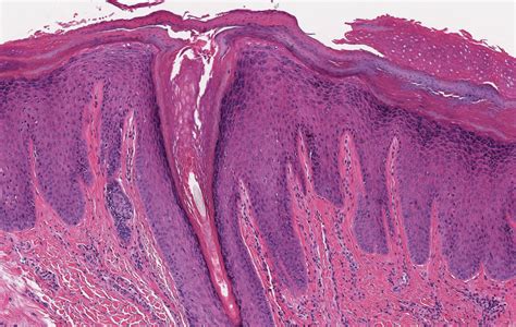 Lichen Simplex Chronicus Histology Best Seafood Restaurants In Panama