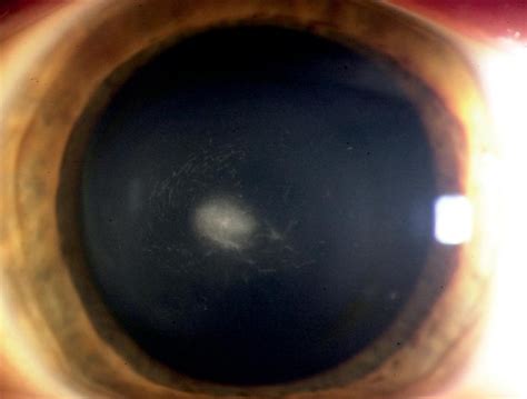 Keratoconus Classification Systems Ento Key