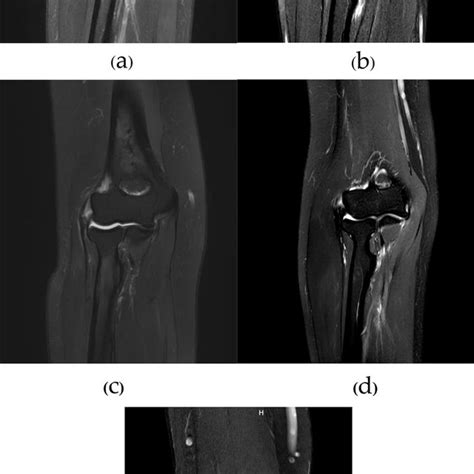 Mri Illustration For The Degree Of Common Extensor Tendon Injuries The