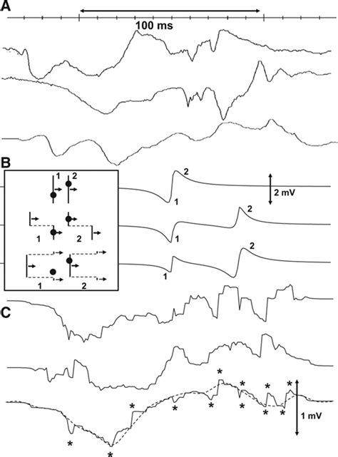 Model Of Bipolar Electrogram Fractionation And Conduction Block Associated With Activation