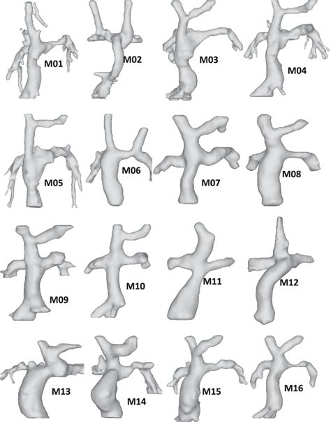 Figure 1 From The Total Cavopulmonary Connection Resistance A Significant Impact On Single