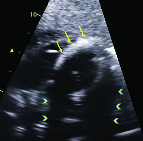 Sepsis Induced Rapid Left Ventricular Calcification Applied Radiology