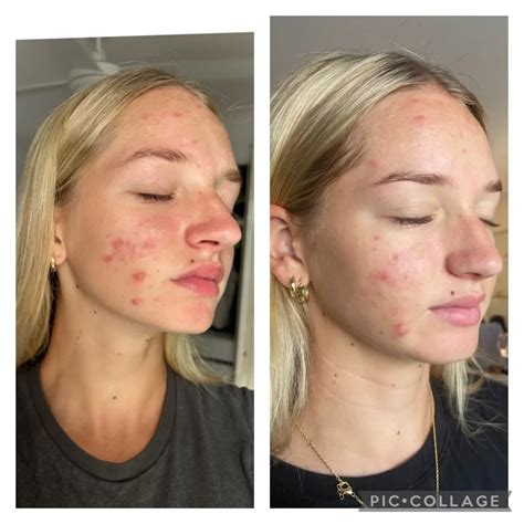 Azelaic Acid Vs Salicylic Acid Which Is Right For Your Skin 2025