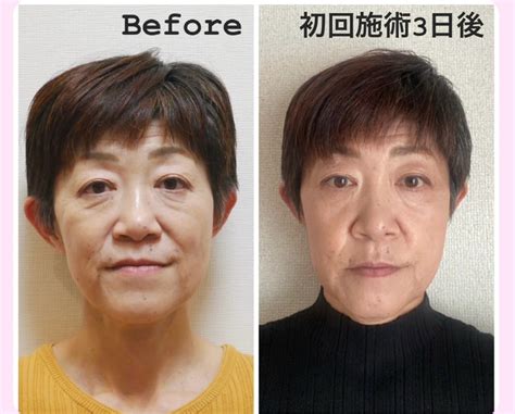 50代は小顔にも綺麗にもならない 福岡 博多駅前 優しい施術で激変していく！！若返りが付いてくるエラ・小顔専門サロン ルフラーズ