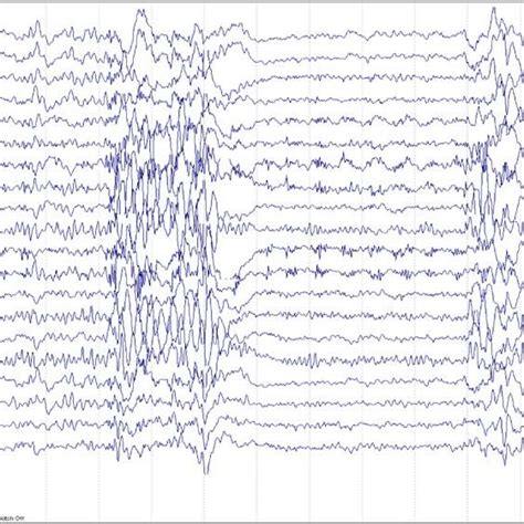 A Twenty Five Year Old Female With Definite PNES In Earlier Video EEG Download Scientific