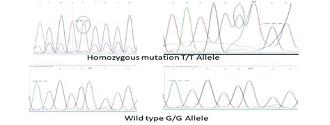 Electropherogram Showing Homozygous Mutations In Jak2 Exon 14 [1849 G