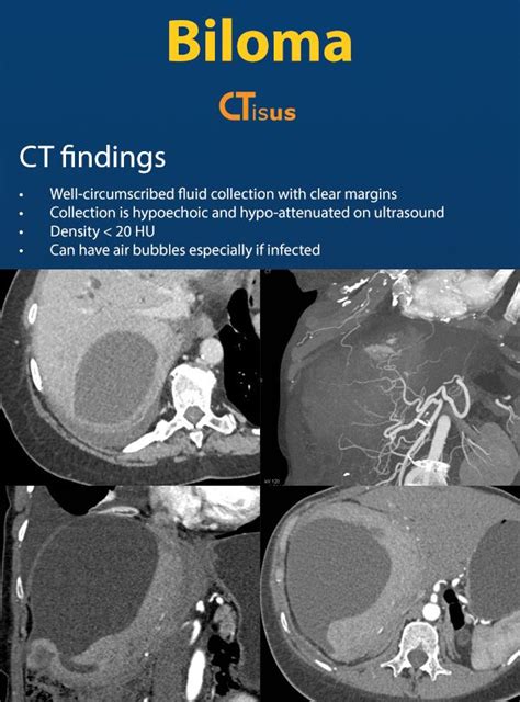 Ctisus On Linkedin Biloma Ct Findings G8wdskc3