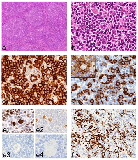 Histology Of Nlphl In Hps2 Patients Lymph Node Biopsy From Pt1 Show Download Scientific