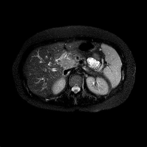 Cholangiocarcinoma Ct