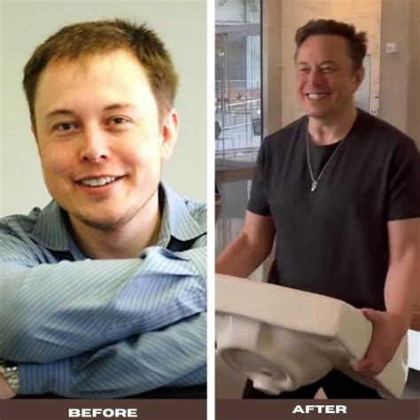 Elon Musk Hair Transplant What You Should Know About The Procedure