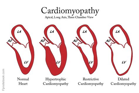 Cardiomyopathy Types Symptoms Diagnosis And Treatment Healthtian