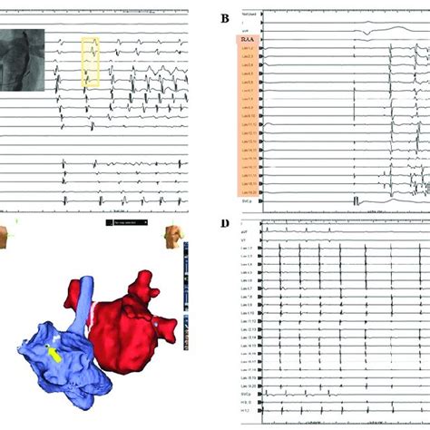 Trigger Sites Of Adenosine Induced Atrial Fibrillation And Recurrence Download Scientific