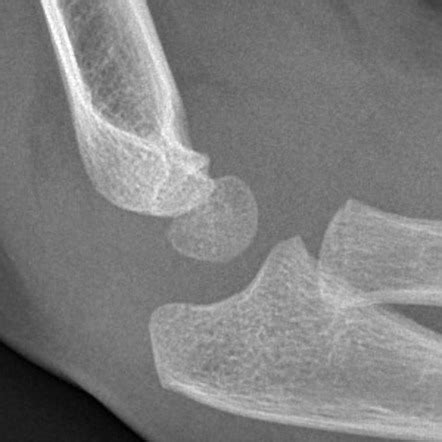 Left Olecranon Fracture Slideseka