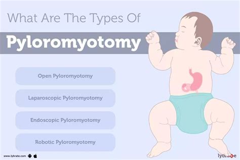 Pyloromyotomy Causes Symptoms Treatment And Cost