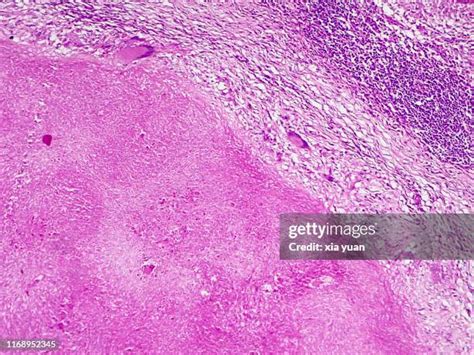Caseous Necrosis Lymph Node