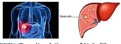 Figure 7 From Liver Cancer Detection Using Hybridized Fully Convolutional Neural Network Based