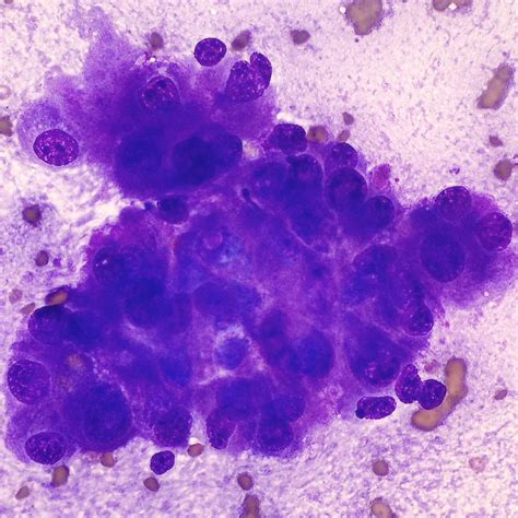Hepatocellular Carcinoma Fna Cytology