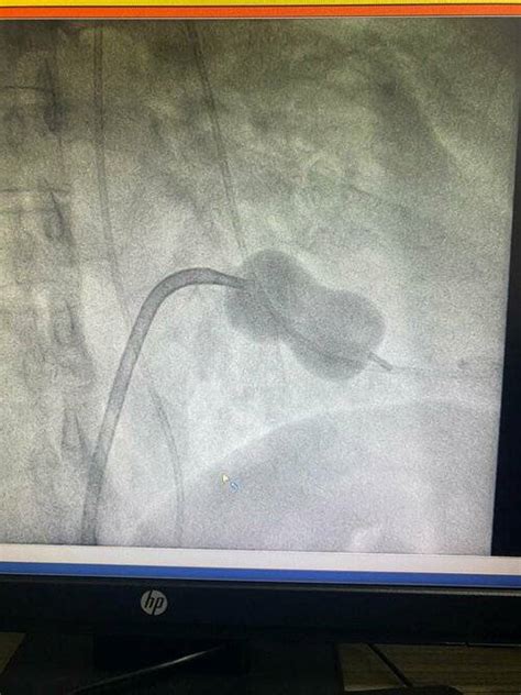 Re Bmv Repeat Balloon Mitral Valvuloplasty Bmv In Rheumatic Mitral