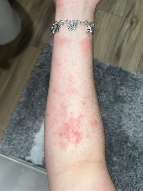 Rash Wont Go Away On Arm And Hand Rdermatologyquestions