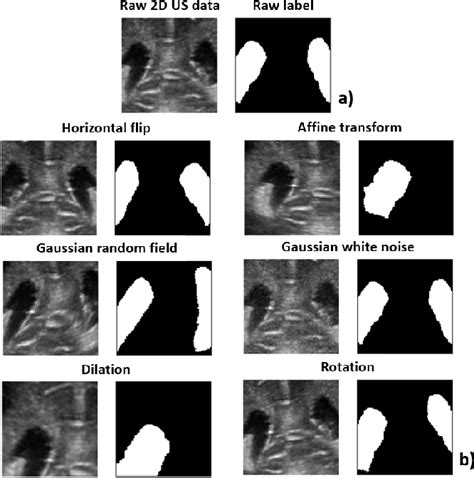 Figure 1 From Segmentation Of Neonates Cerebral Ventricles With 2d Cnn In 3d Us Data Suitable