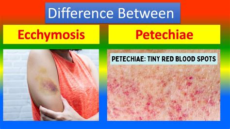 Distinction Between Ecchymosis And Petechiae YouTube
