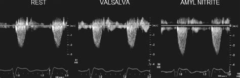 Continuous Wave Doppler Tracing Of The Lvot Shows The Peak Pressure Download Scientific Diagram Continuous Wave Doppler Tracing Of The Lvot Shows The Peak Pressure Download Scientific Diagram