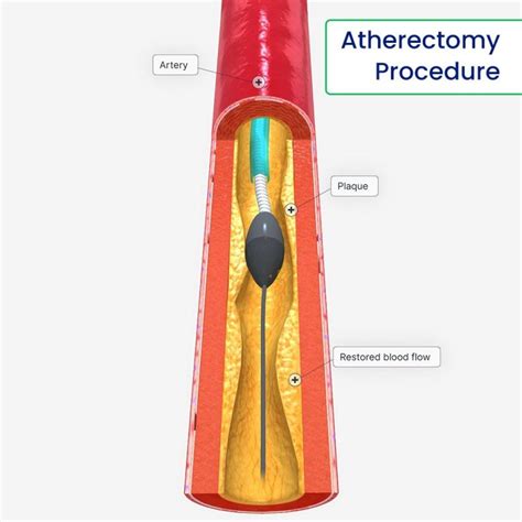 Atherectomy In Downtown Brooklyn New York Downtown Vein And Vascular