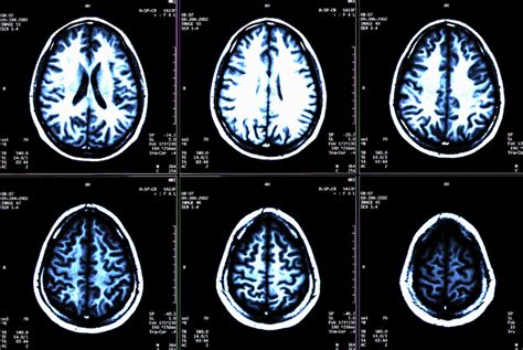 Rituximab In Multiple Sclerosis Better Efficacy Lower Discontinuation