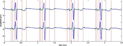 Segmentation Results For A Typical Ecg Signal Including The Onset And