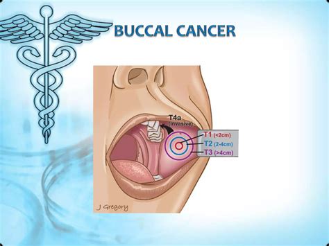 Tnm Staging Of Oral Cancer Ppt