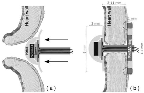 Schematic Views Of The Endocardial Accelerometer A Insertion Through