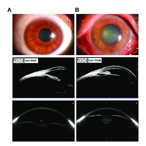 Using Anterior Segment Oct As Oct In Comparison With Other Imaging Of Download Scientific