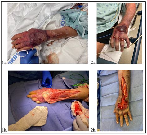 Early Necrotizing Fasciitis