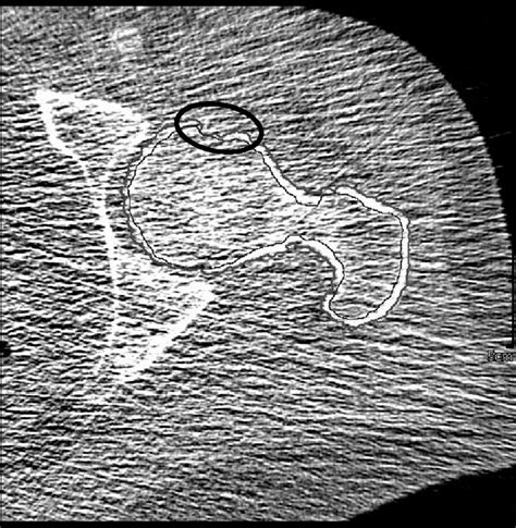Effect Of Noise Enhancement On Segmentation In Ct Dataset Of A Proximal Download Scientific