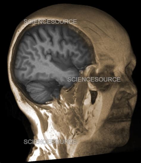Mri Scan Brain 3d