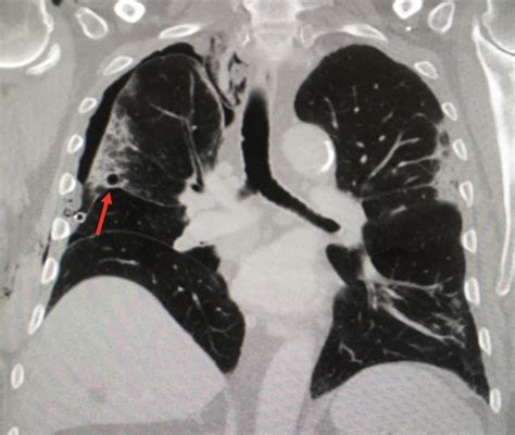Pulmonary Cystic Lesions The Operative Review Of Surgery