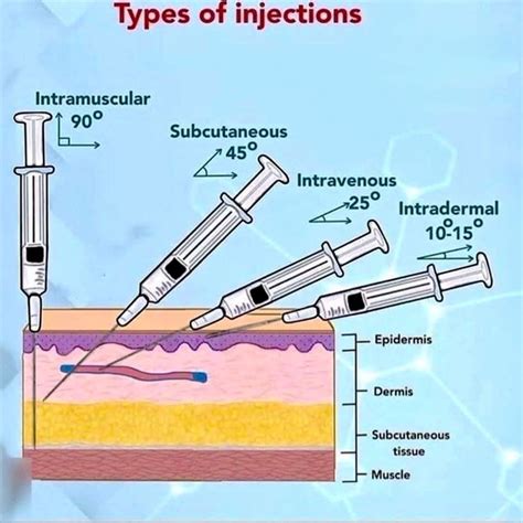 Types Of Injection Album On Imgur