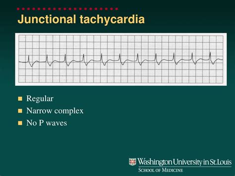 Ppt Telemetry Arrythmias Powerpoint Presentation Free Download
