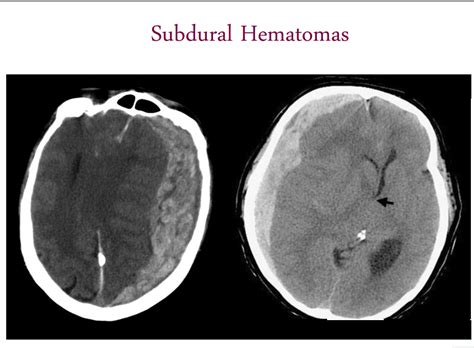 Epidural Subdural Subarachnoid Hemorrhage Maternity Photos A Case Of