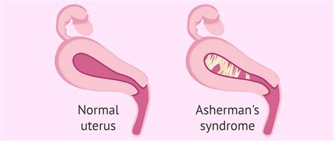 Ashermans Syndrome Grading Symptoms Causes And Fertility